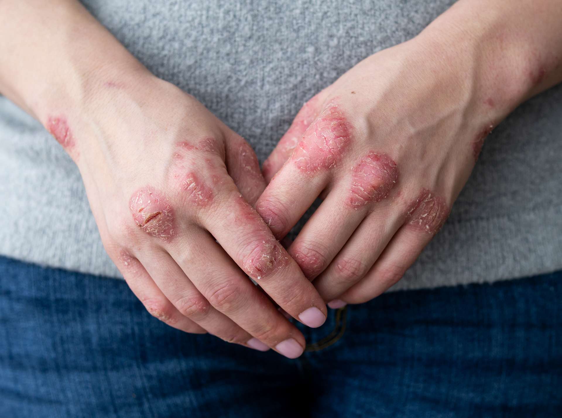 La sévérité du psoriasis pourrait être liée à une carence en vitamine D