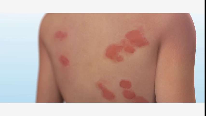 L’urticaire : causes et traitements