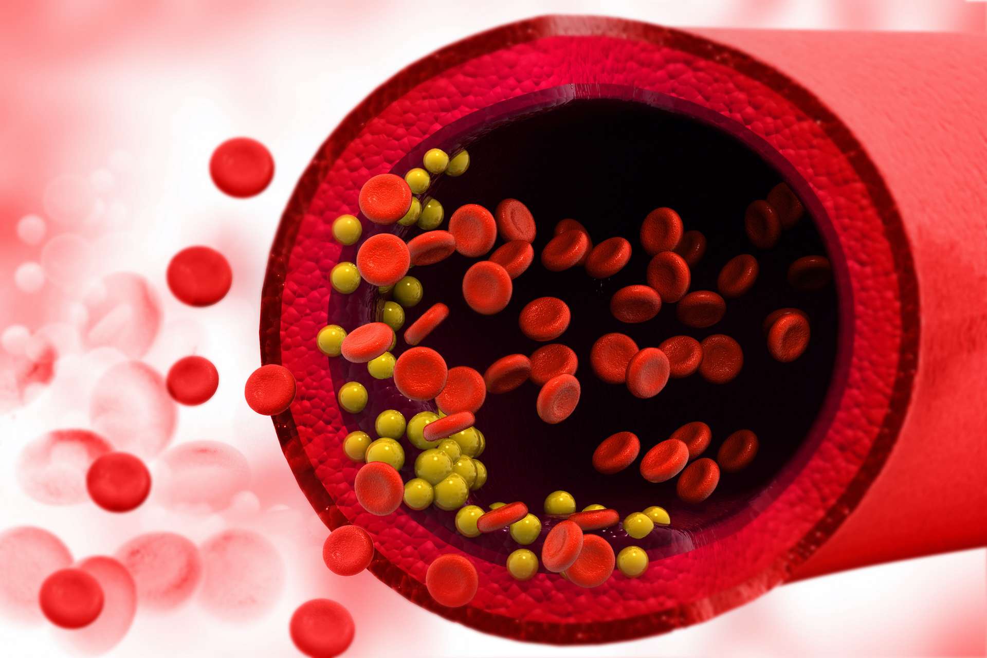 Définition | Dyslipidémie - hypercholestérolémie - hyperlipidémie