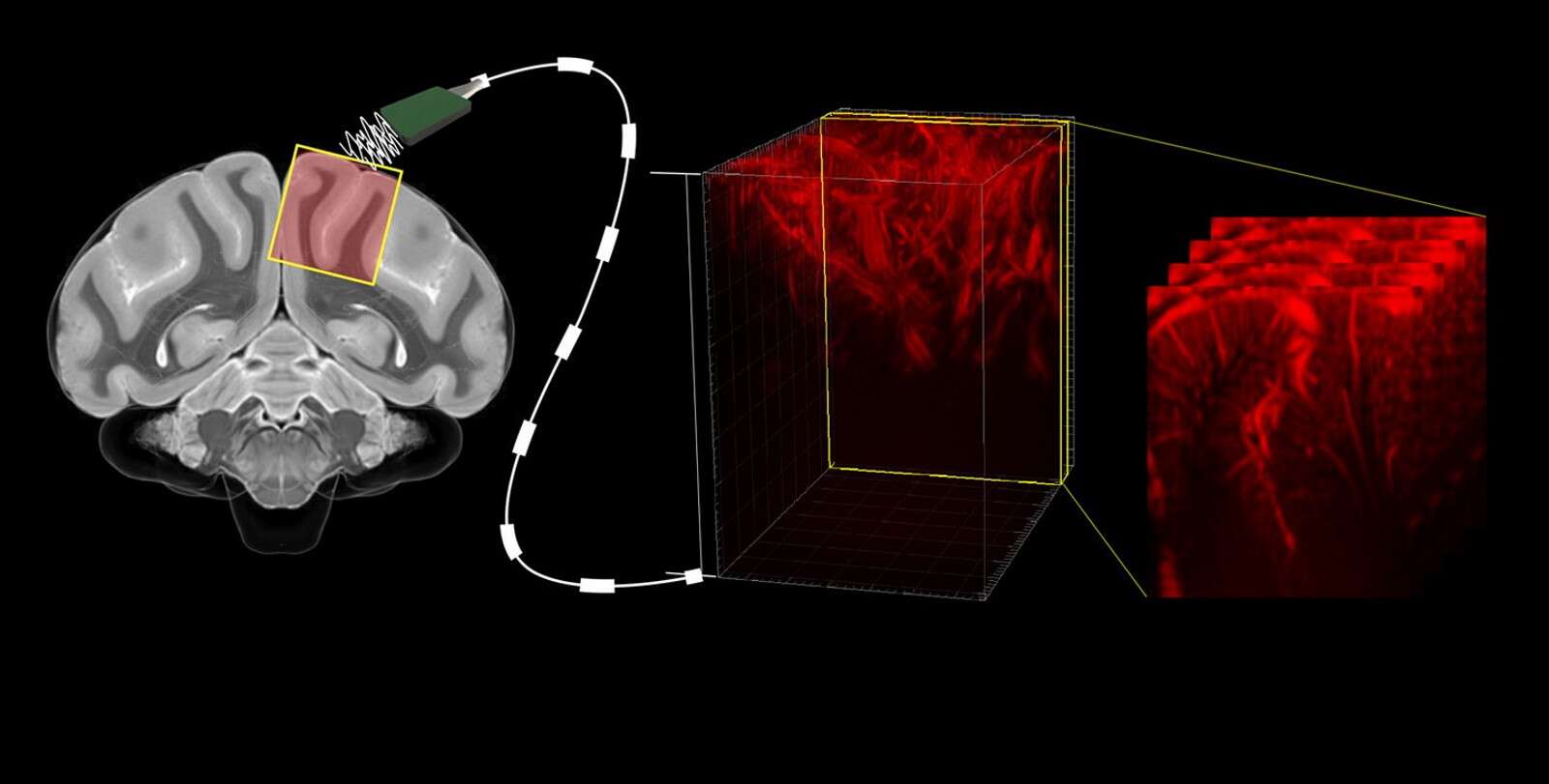 Interface cerveau-machine : des ultrasons pour faire parler le cerveau