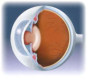 Cataracte : causes et traitement | Dossier