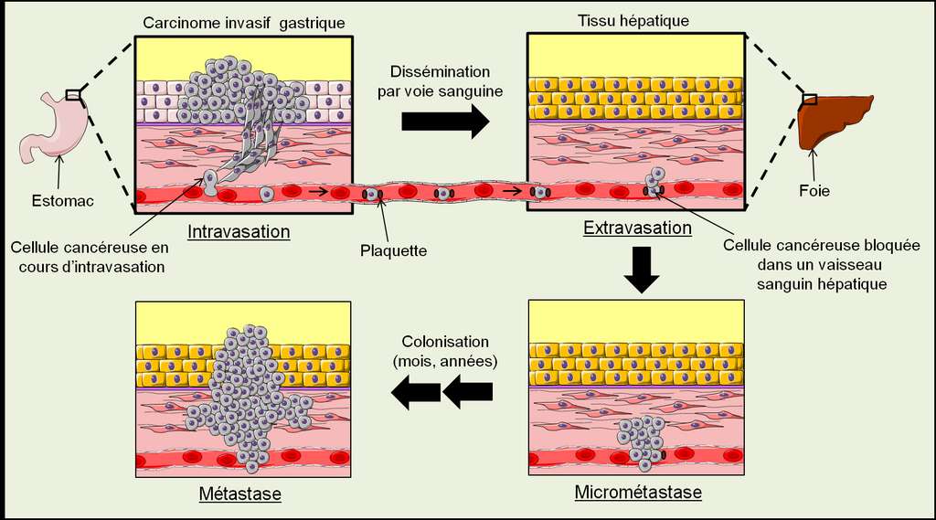 Le cancer métastatique : intravasation, extravasation et colonisation ...
