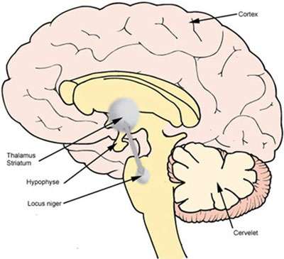 Caractéristiques de la maladie de Parkinson au niveau du cerveau | Dossier