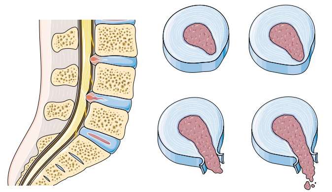 Hernie discale : un disque intervertébral en cause | Dossier