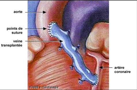 Athérosclérose : prévention et traitements | Dossier