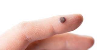 Verrues : quels traitements pour les enlever