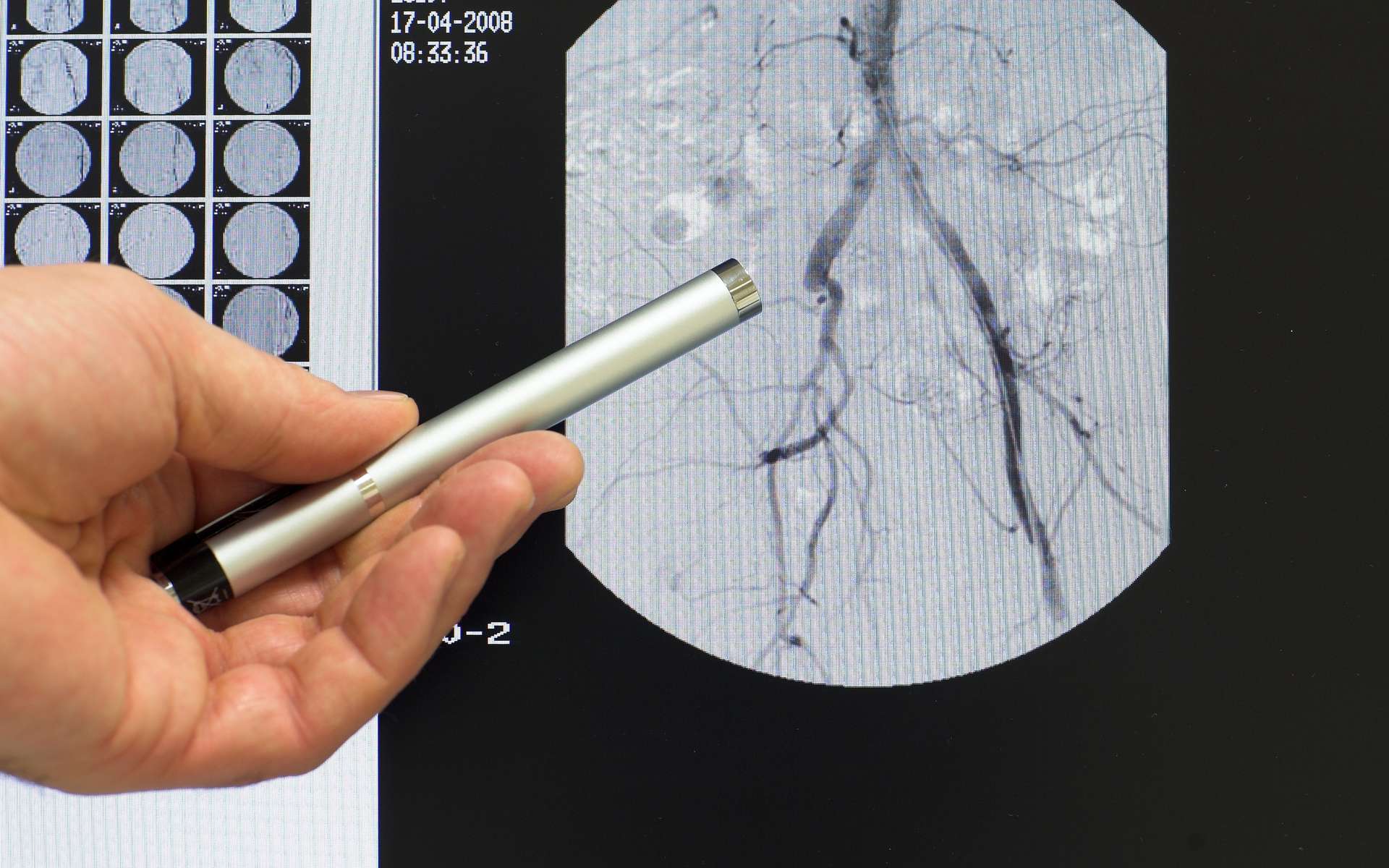 Définition | Angiographie - Angéiographie | Futura Santé