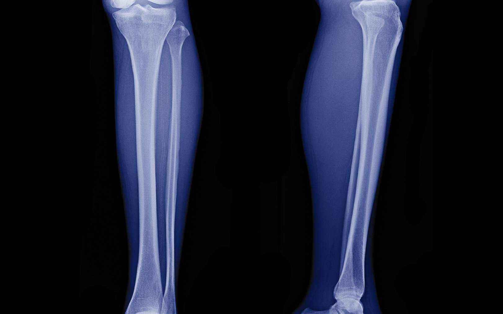 Définition | Épiphyse - Glande pinéale | Futura Santé