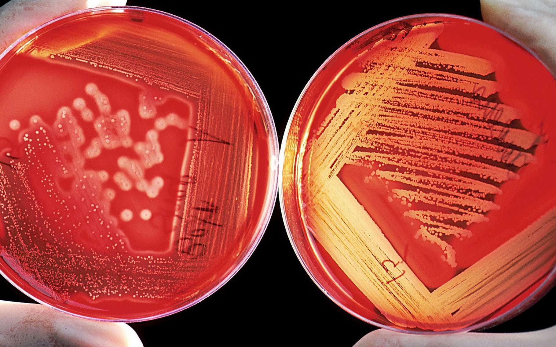 Cystite infectieuse : symptômes et diagnostic | Dossier