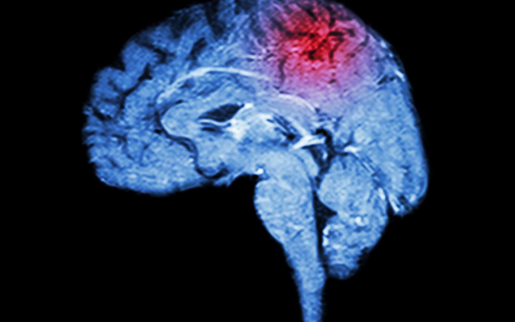 Vidéo | Comment prévenir un AVC