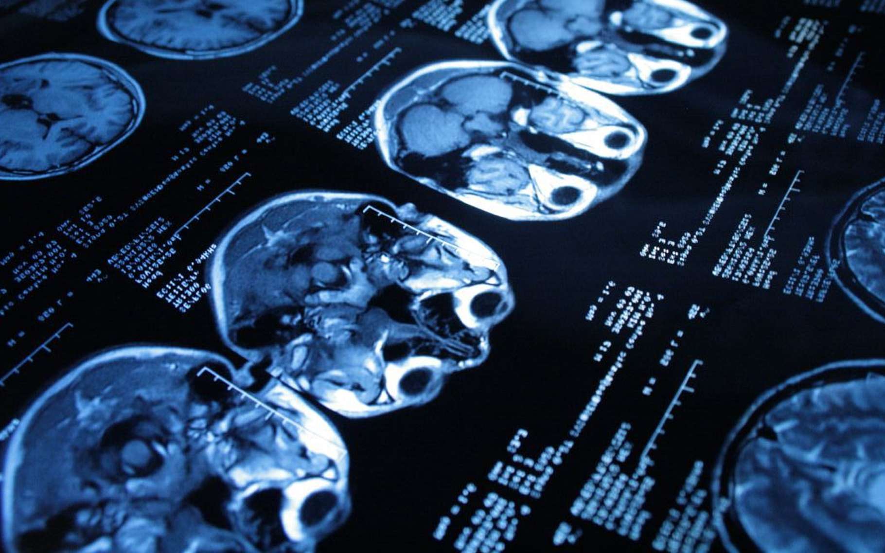 RMN, tout sur la résonance magnétique nucléaire | Dossier