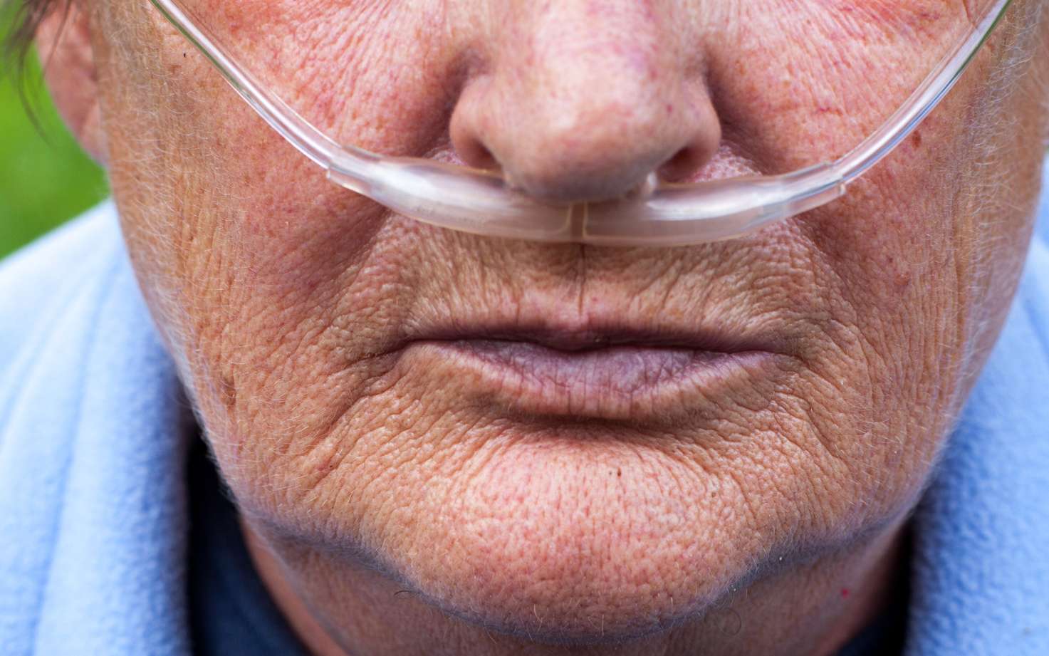 Définition | BPCO - Broncho-pneumopathie chronique obstructive ...