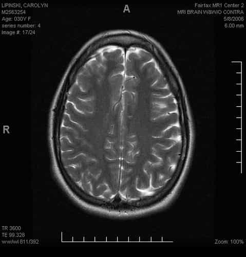 Cancer : des tumeurs au cerveau détruites au laser en deux minutes